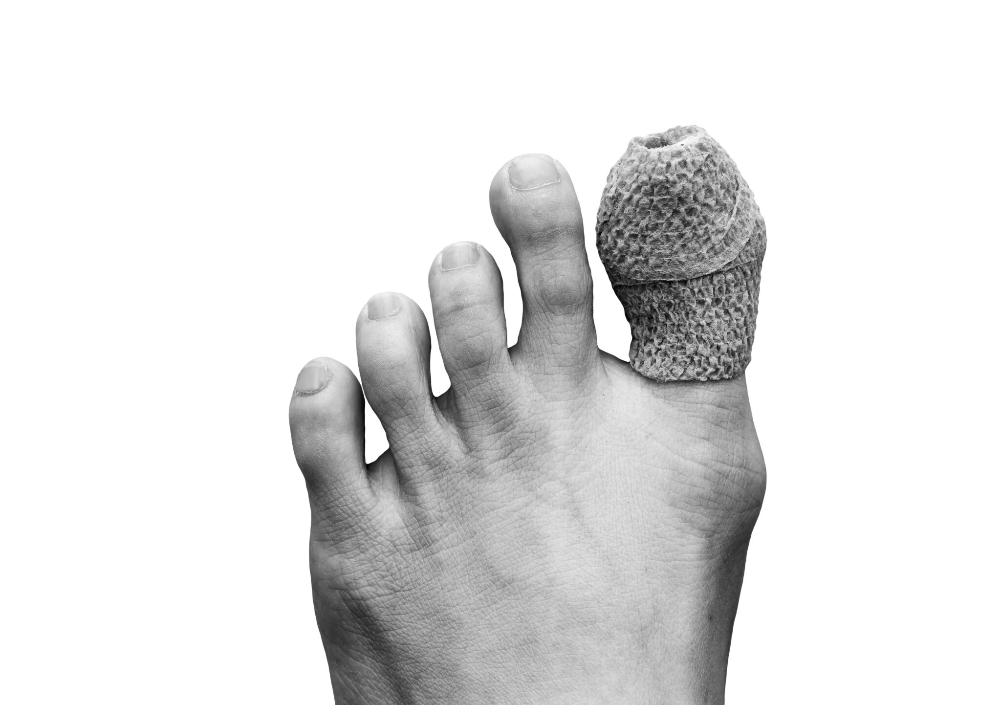 Bruised Toe: When Is It More Than Just a Bruise? - Curalta Foot + Ankle
